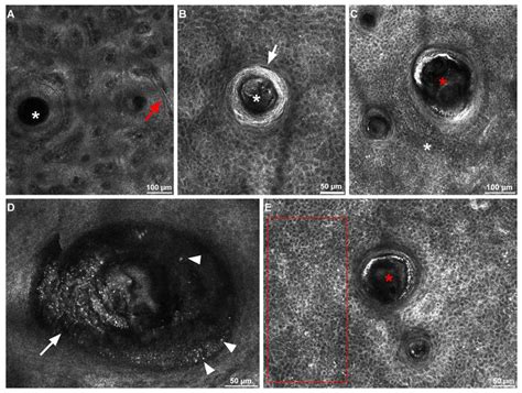 Pimple Microscope Pimple Microscope