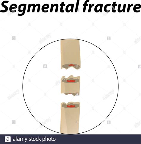 Segmental Fracture Bone Infographics Vector Illustration On A Lined Background Stock Vector