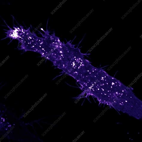 Ewing Sarcoma Cancer Cell Light Microscopy Stock Video Clip K014