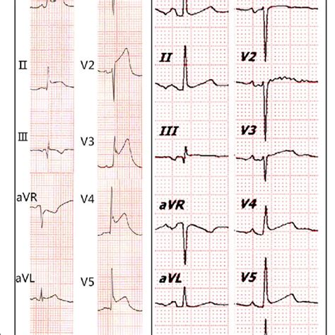 A Widespread Concave St Segment Elevation Was Present In Download Scientific Diagram