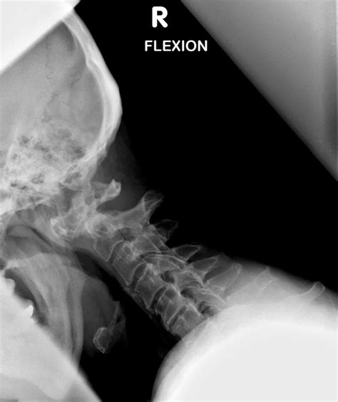 Dislocated Neck Vertebrae