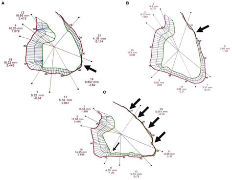 Three Typical Examples Of Right Ventricular Rv Segmental Wall Motion Download Scientific