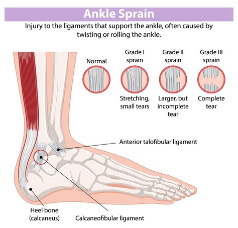 Grade 1 Ankle Sprain Inversion Or Lateral Ankle Sprain Pivotal