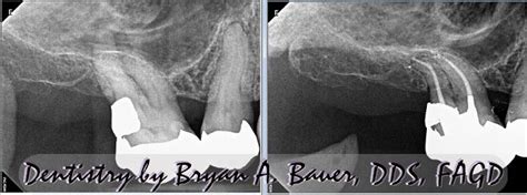 Root Amputation When To Consider Bauer Smiles