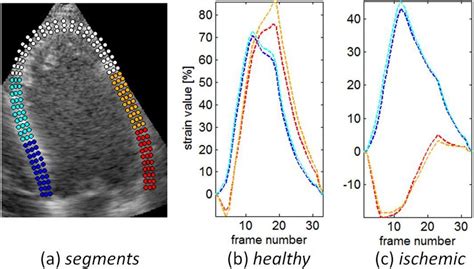 Segments Definition A Basal And Mid Inferoseptal Blue And Cyan