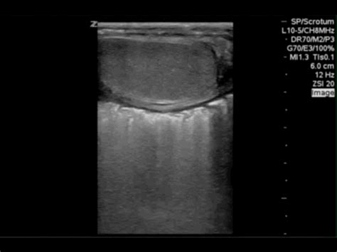 Fourniers Gangrene Image Collection Ultrasound In Resource Limited