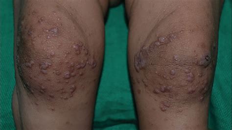Heat Rash Heat Rash Or Prickly Heat Miliaria Rubra Condition