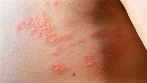 Tratamiento Del Herpes Zóster Precio Del Tratamiento Para La
