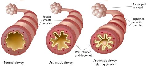 What Is Asthma What Are Asthma Symptoms Causes Treatments And Prevention SimpleBiology