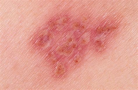 Herpes Simplex Picture Hardin MD Super Site Sample