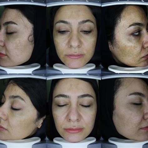 Treatment With TXA Mesoneedling On The Left And TXA Microinjection On Download Scientific