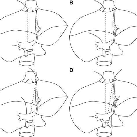 Types Of Hepatectomy Using Hanging Maneuver N 187 Download