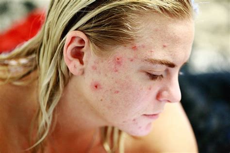 3 Best Tips To Avoid Acne Breakouts TWLSkin Dermatologist SG