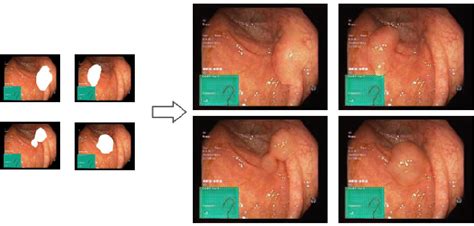 Figure 4 From Gan Based Realistic Gastrointestinal Polyp Image Synthesis Semantic Scholar