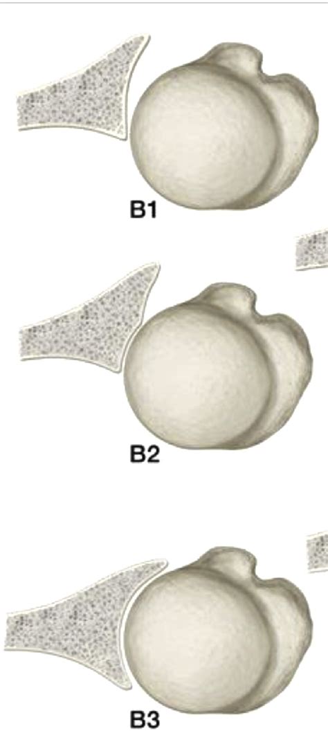 Shoulder Arthritis Joint Replacement Shoulder Arthritis With Type B Glenoids