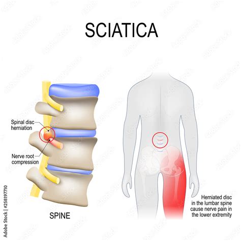 Sciatica Scheme With Vertebrae Disks And Nerves Human Body From Back