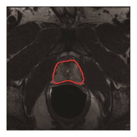 challenges in segmenting prostate in mr images a imaging artifacts
