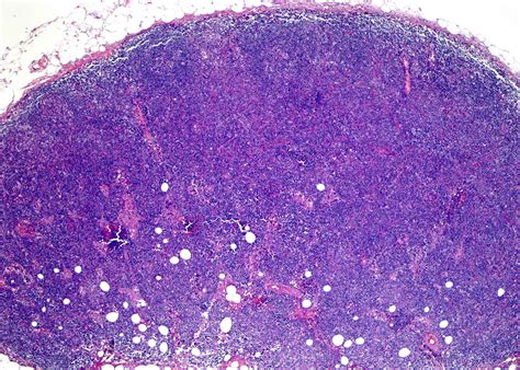 Pathology Outlines Ebv Related Lymphoid Proliferations