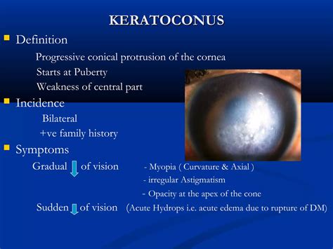 Cornea For Undergraduate Ppt