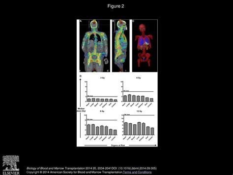 Combination Of Linear Acceleratorbased Intensity Modulated Total Marrow Irradiation And