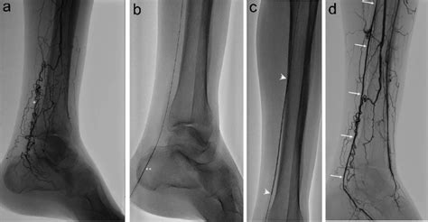 A D Initial Angiogram Showing Completely Occluded Distal Posterior