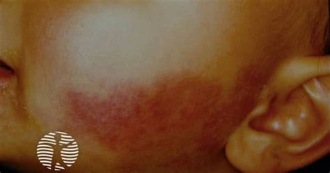 Dermnet® Vascular Malformation Image