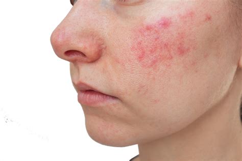 Rosacea How To Improve And Maintain Your Skins Health Skinbase™ Europe Ltd