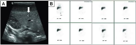 A Abdominal Sonography Shows Collapsed Gallbladder Arrow B Download Scientific Diagram