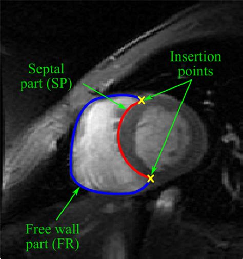 Figure 1 From Segmentation Of The Right Ventricle In Mri Images Using A