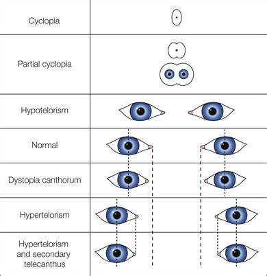 Ocular Hypertelorism Symptoms Ocular Manifestations Of Chromosomal
