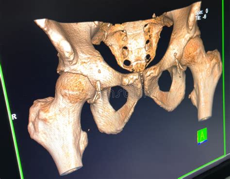 Close Up Of Ct Scan With Bones Medicine Science And Education Mri