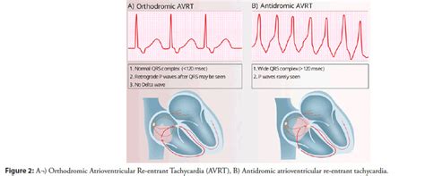 Ventricular Pre Excitation In Asymptomatic Pediatric Patients And