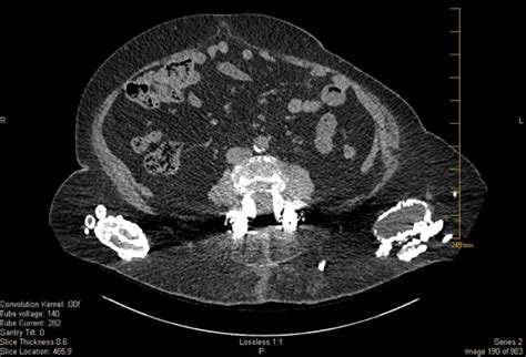 Calcifications Due To Estrogen Injections PMC