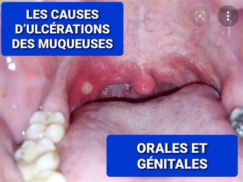 UlcÉrations Des Muqueuses Orales Et GÉnitales Santé Médecine