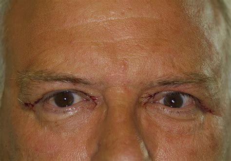 Cosmetic Eyelid Surgery Conlon Eye Institute