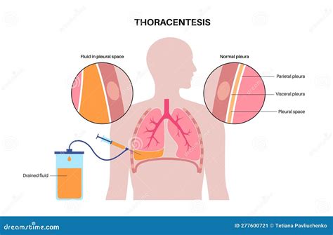 Thoracentesis Medical Procedure Cartoon Vector 277600721