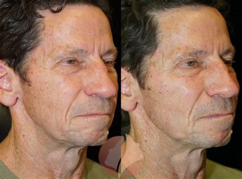 Pdo Thread Lift Before And After Photo Gallery Saratoga Ca Laface
