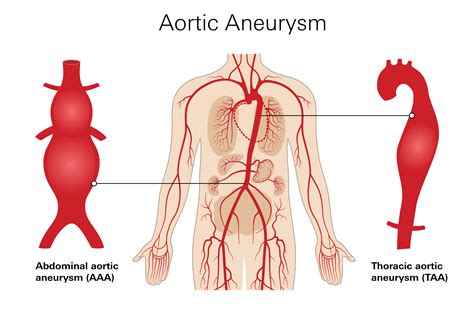 Aortic Aneurysm Causes Treatments And Medication Options