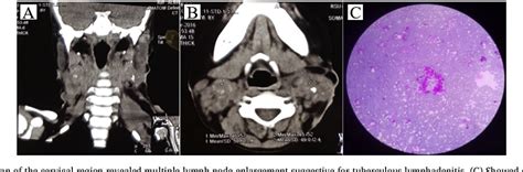 Figure 1 From A Very Rare Case Of Scrofuloderma With Multiple Cervical