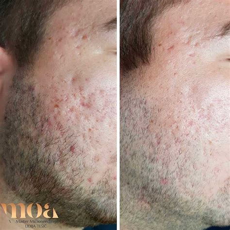 Microneedling Depth Guide Through Areas And Concerns