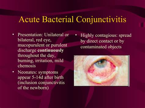 Conjunctivitis Ppt