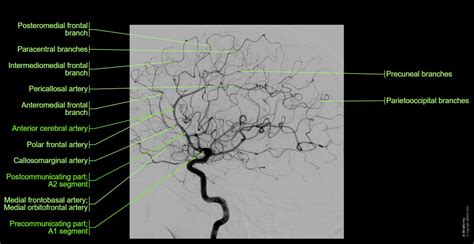 Posterior Cerebral Artery Angiogram
