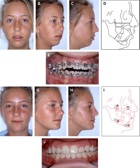 Anterior Open Bite Correction By Le Fort I Or Bilateral Sagittal Split