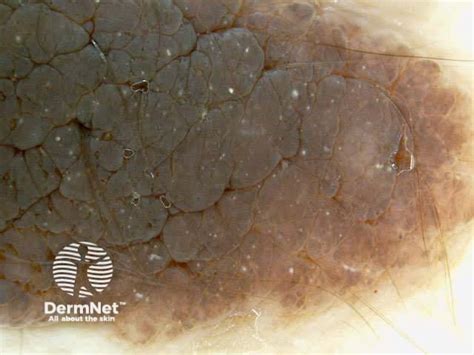 Dermoscopy Benign Melanocytic Lesions Dermoscopy Benign Melanocytic Lesions