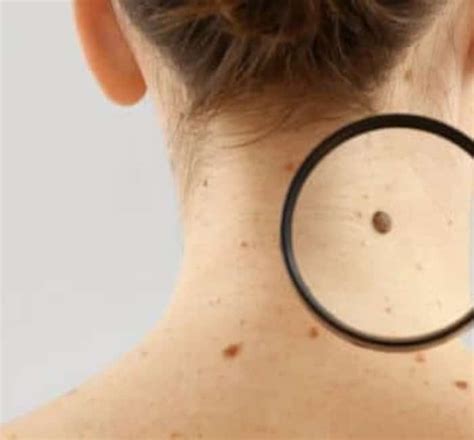 Skin Lesion Excision Consultant Anca Breahna Plastic Surgeon