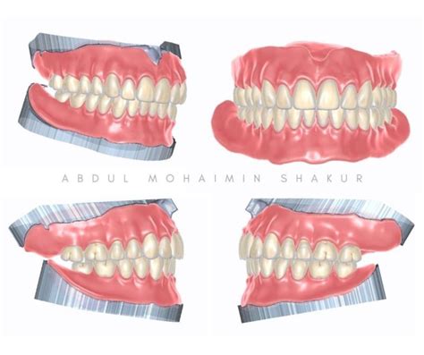 Abdul Mohaimin Shakur On Linkedin Dentalcad Caddesign