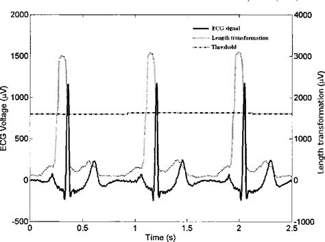 Figure 24 From The Fetal Electrocardiogram Determination Of The Fetal Heart Rate And