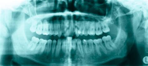 Hyperplasie Des Processus Coronoideus Zm Online