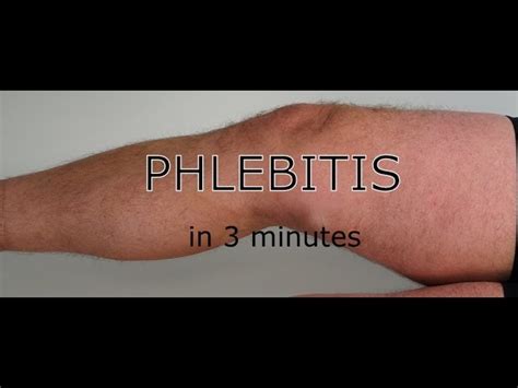 Phlebitis