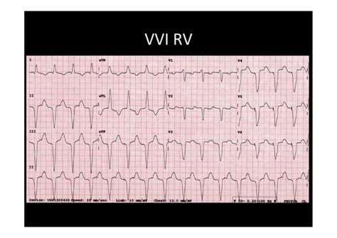 Pacemaker Mediated Tachycardia Or Not Pdf